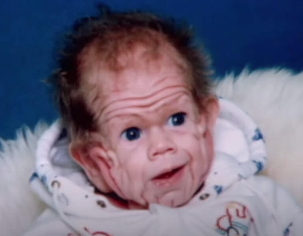 Tomm Tennent: Baby Born with Skin for 5-Year-Old