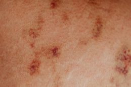 Blood Clot Warning Signs