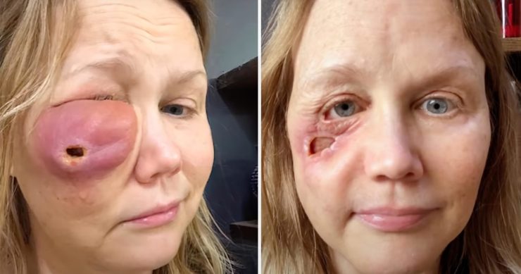 Gina Anderson: From Filler Failure to Today, 4 Years Later