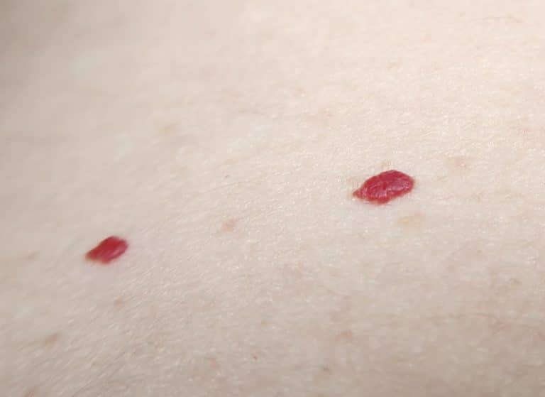 Cherry Angiomas, the Tiny Red Spots on Your Body