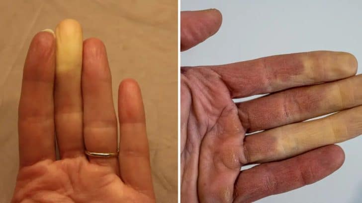 Raynaud's Phenomenon: Why Fingers Turn White in the Cold