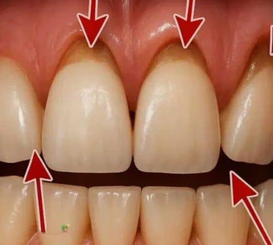10 Natural Ways to Calm Gum Irritation at Home